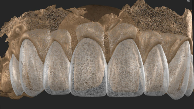 Dentogenics | Composite Bonding Stents | Dental Design