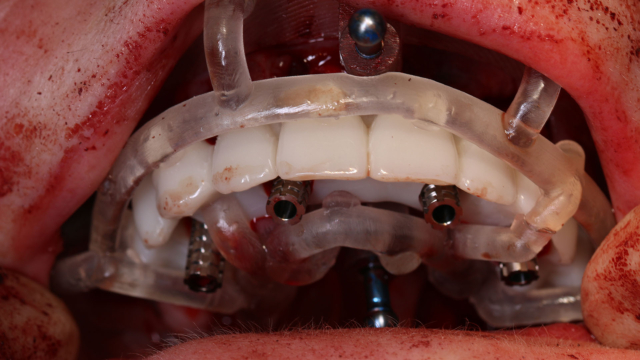 Dentogenics | Implant Planning and Surgical Guides